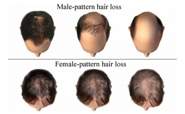 Androgenic Alopecia | AA KLINIK